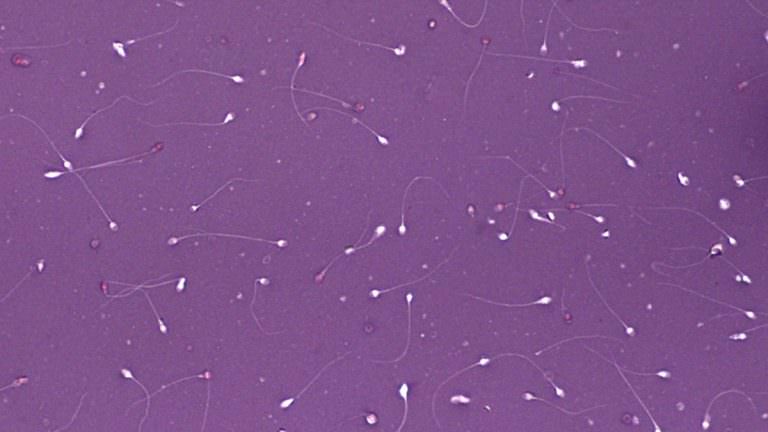 The Parameters Of Semen Analysis - Eργαστήριο Ανδρολογίας Ζεγκινιάδου